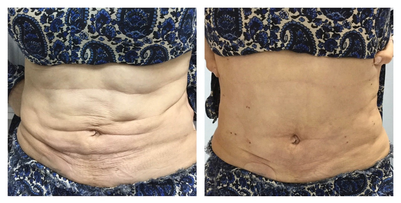 PDO Threads – Governors Medspa & Concierge Medicine