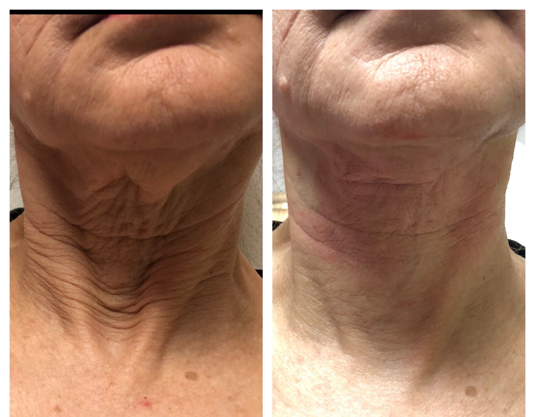 PDO Threads – Governors Medspa & Concierge Medicine PDO Threads – Governors Medspa & Concierge Medicine