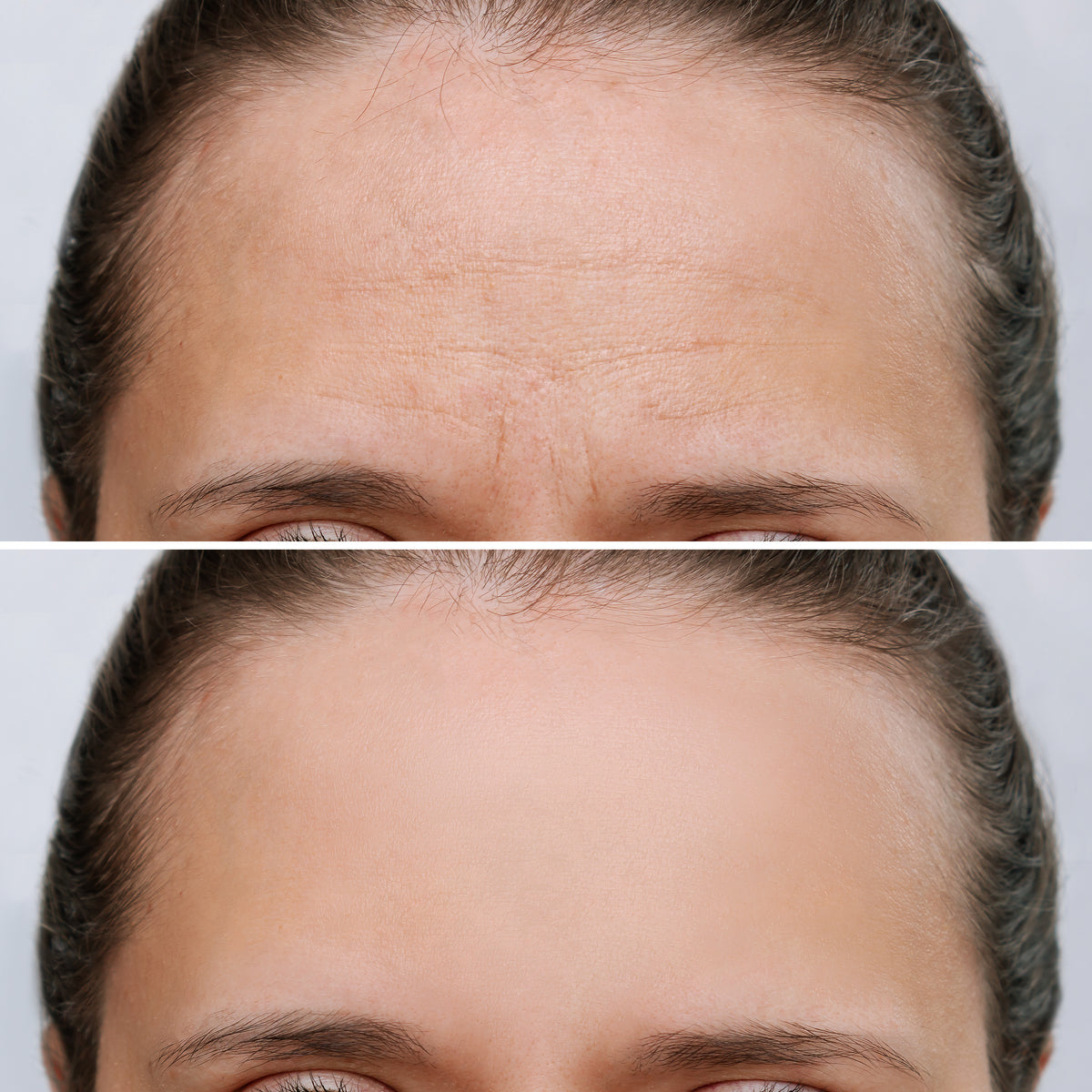Botox – Governors Medspa & Concierge Medicine